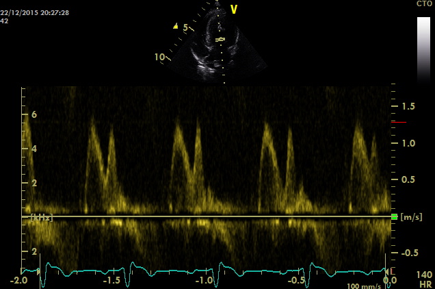 stenosi subaortica – ecovetsos