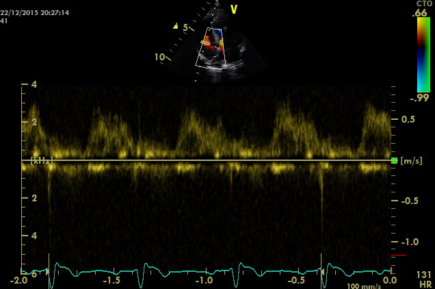 stenosi subaortica – ecovetsos
